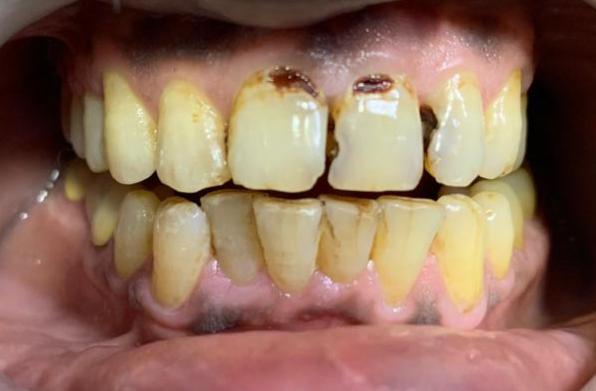 How to get rid of smoking stains on teeth in 2025?