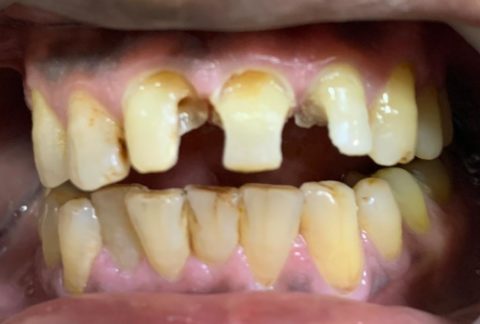 How to get rid of smoking stains on teeth in 2025?