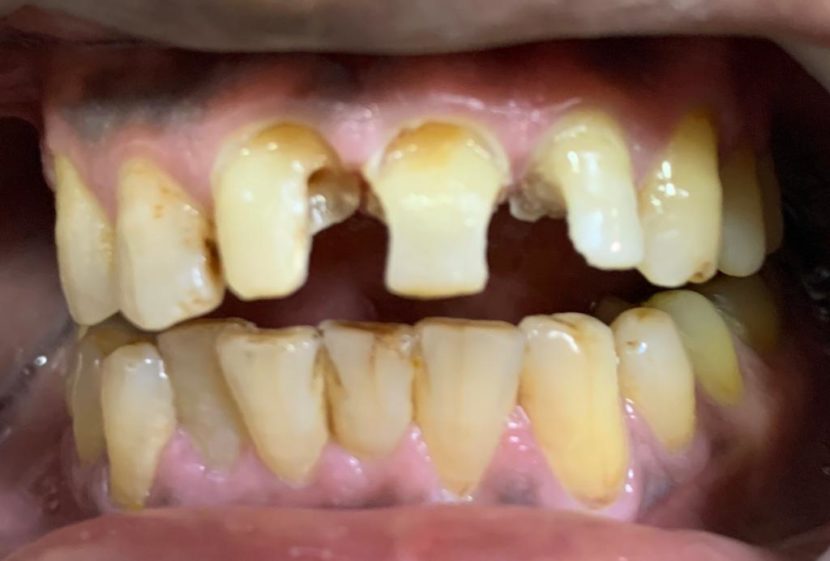 How to get rid of smoking stains on teeth in 2025?