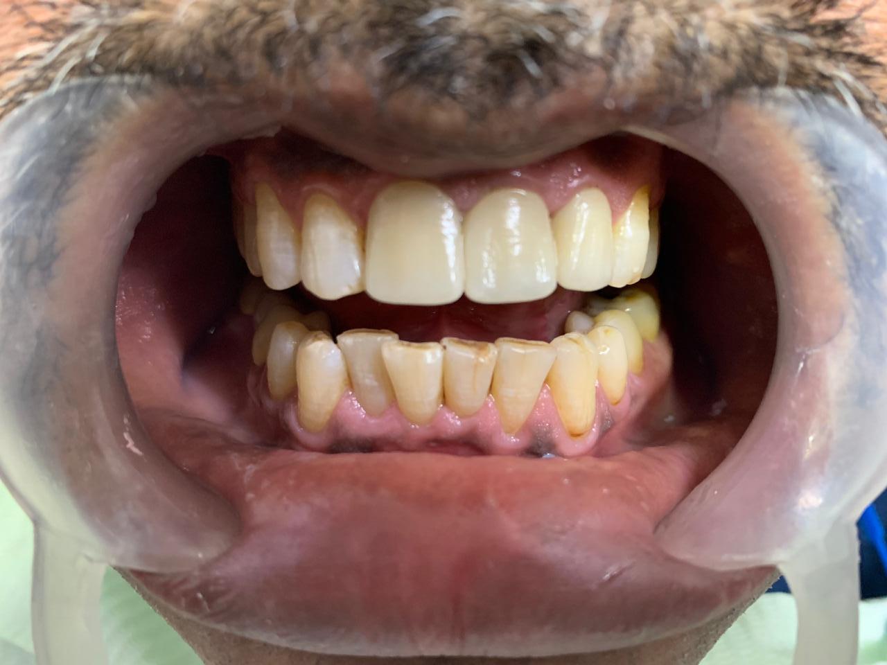 How to get rid of smoking stains on teeth in 2025?